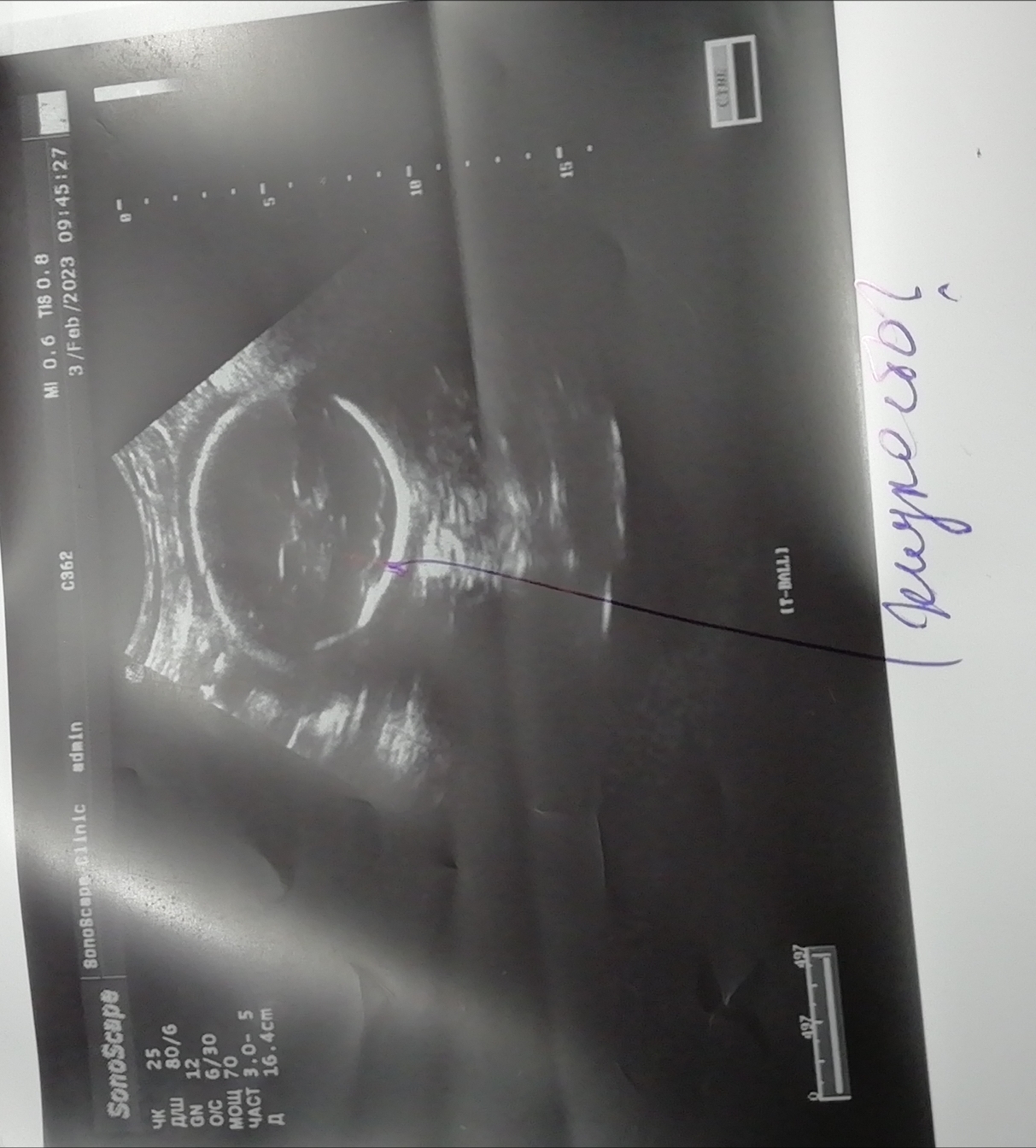 Подозрения на ВПР головного мозга у плода Беременность 28 недель. Два | MedAboutMe