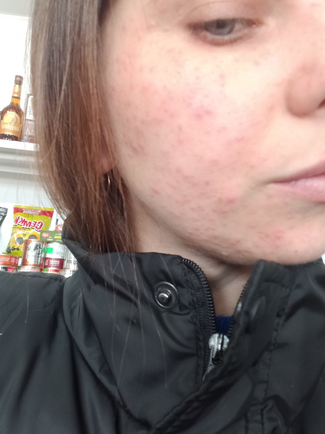 Подкожные прыщи на лице Подкожные прыщи на лице которые уже 2 месяца