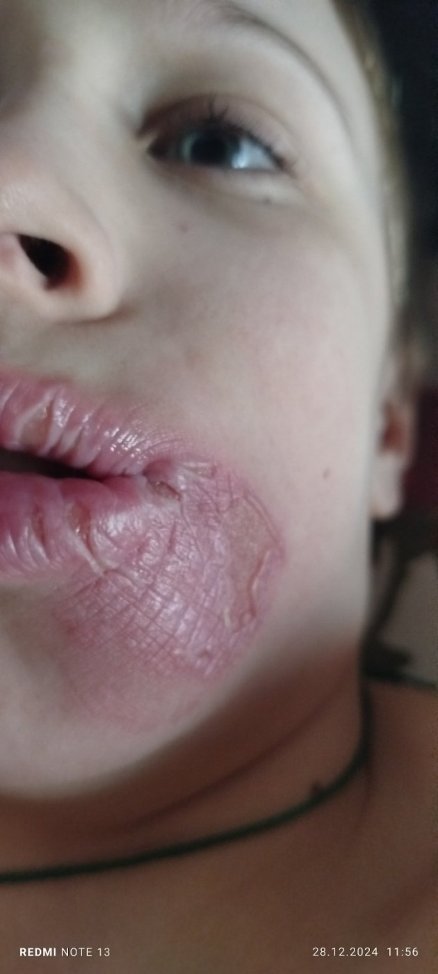 Покраснение и зуд на лице У ребёнка 13 лет появилось покраснение на лице, | MedAboutMe